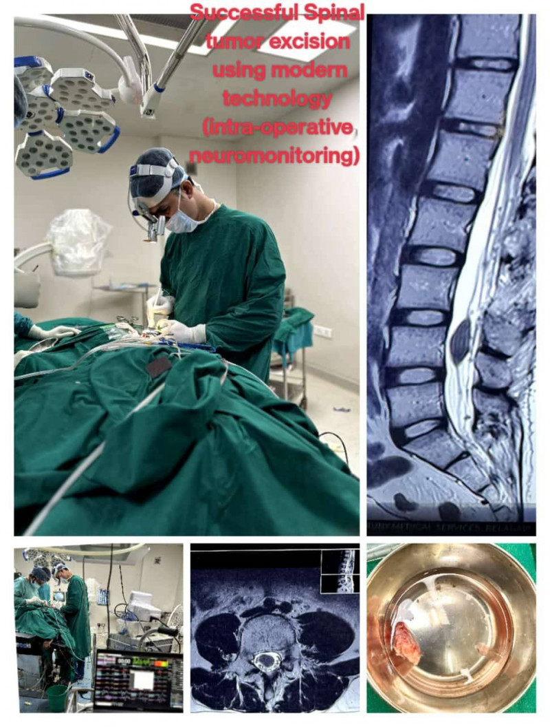 Spinal Tumors: Causes, Symptoms, Diagnosis, and Advanced Surgical ...